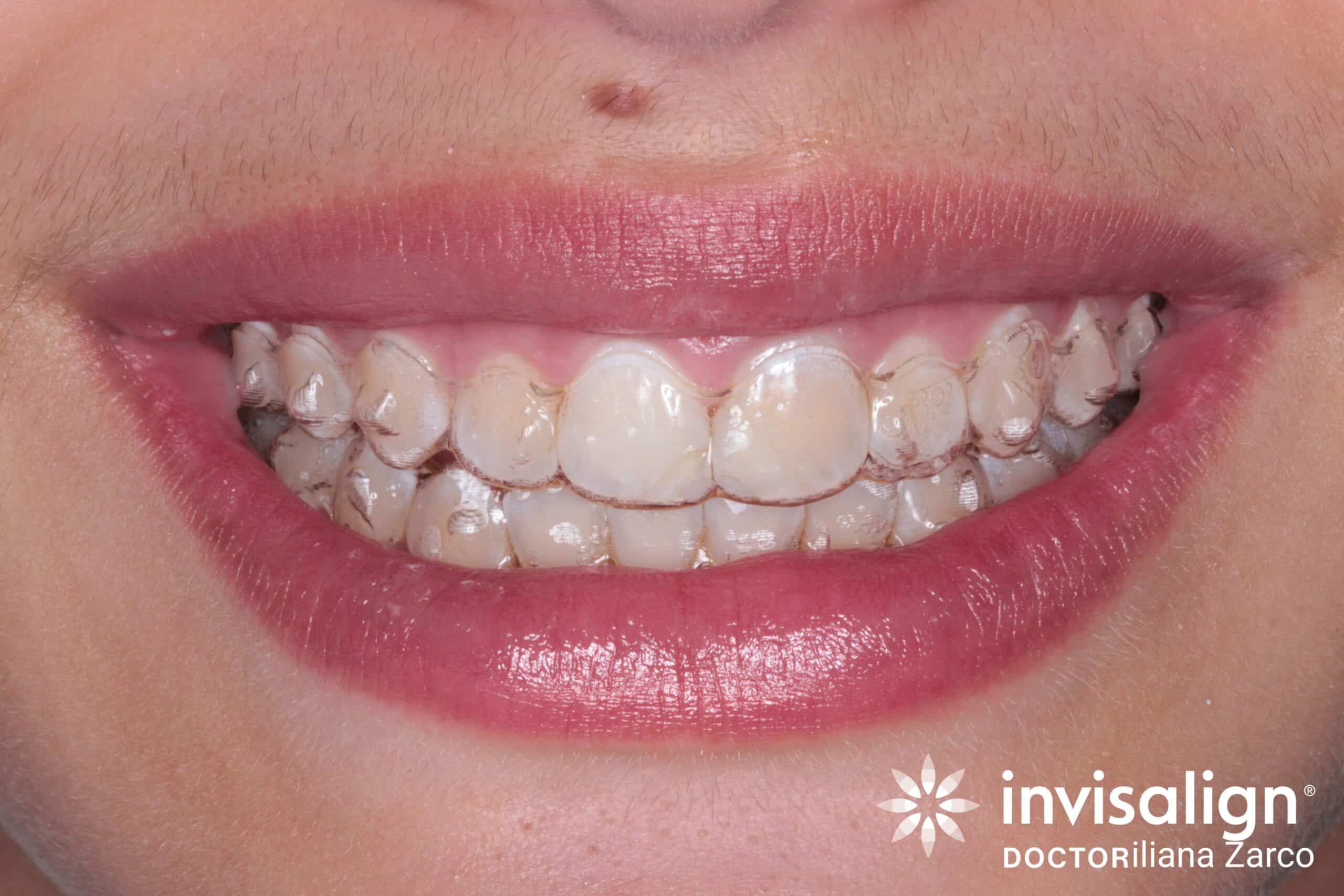 Ortodoncia con alineadores Invisalign/Smartee – Iliana Zarco & José Cuesta