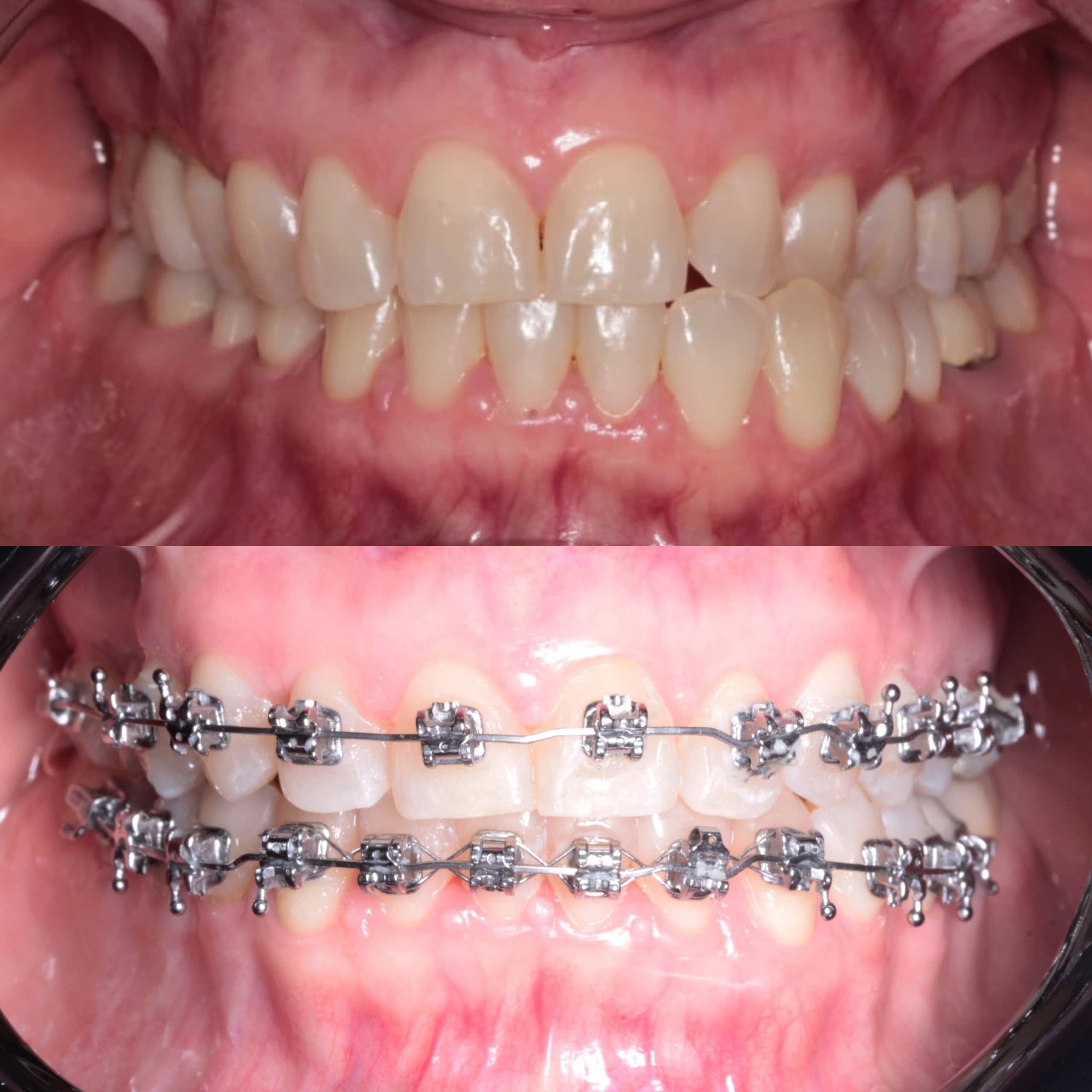 Brackets Autoligado – Iliana Zarco & José Cuesta